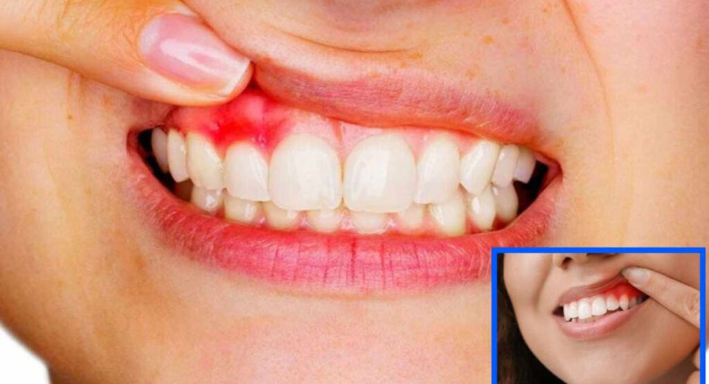 Swollen Gums: చిగుళ్ళు వాపు నొప్పి సమస్యతో బాధపడుతున్నారా…. ఈ చిన్న ...